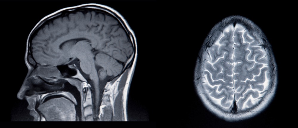 SPECT vs PET | Fastest Clinical Research Organization | TRACER