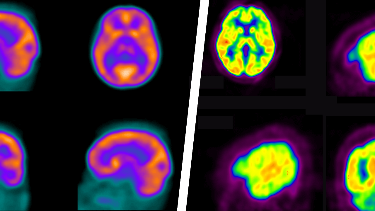 SPECT vs PET | Fastest Clinical Research Organization | TRACER